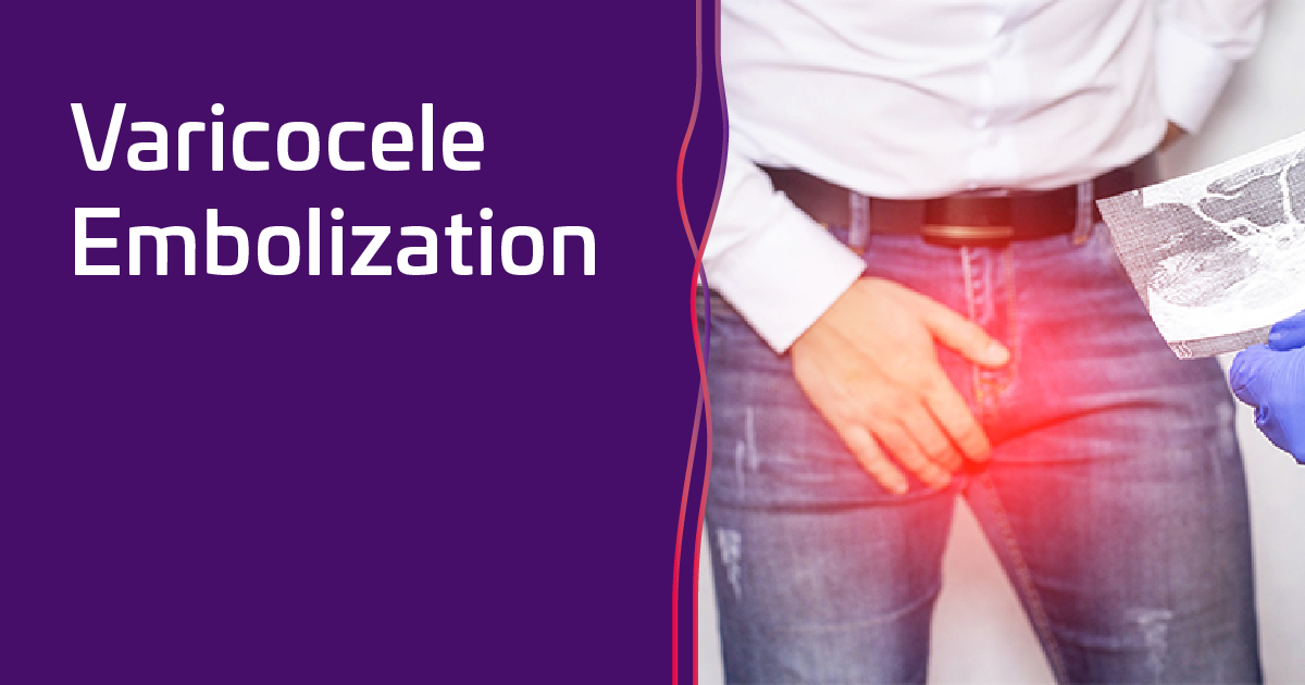Best Varicocele Embolization in Hyderabad | RIVEA Vascular Institute